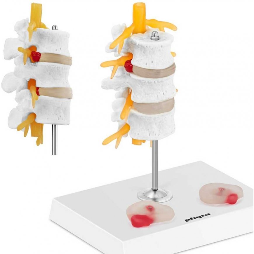Physa 3D anatomical model of the lumbar spine with herniated vertebrae ...